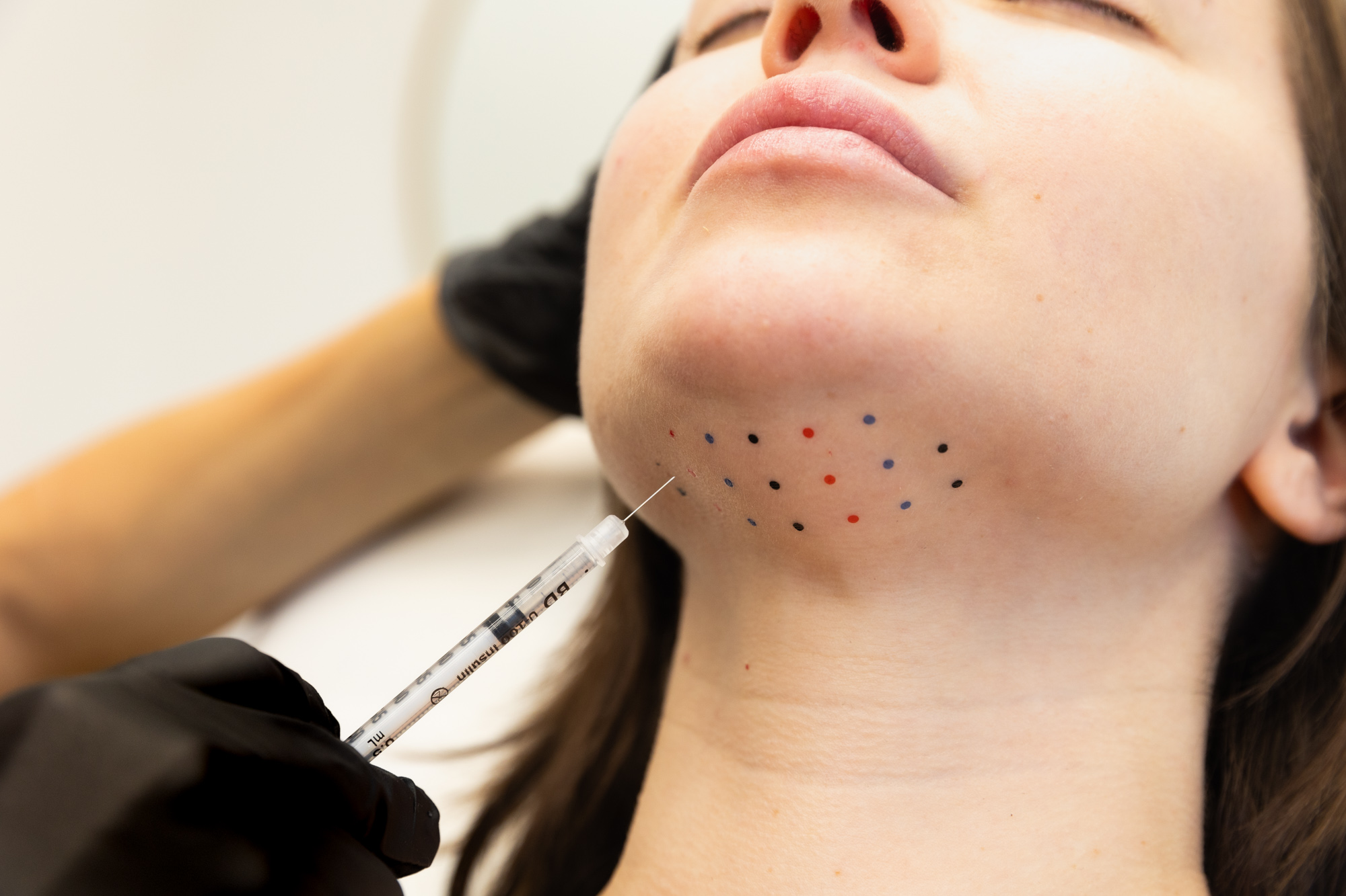 Kybella Treatment Fishers Indiana | Best Kybella Injections